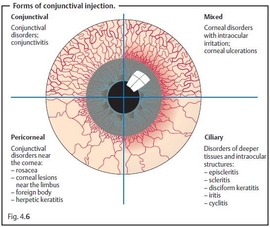General Notes On The Causes Symptoms And Diagnosis Of Conjunctivitis General Notes On The Causes Symptoms And Diagnosis Of Conjunctivitis
